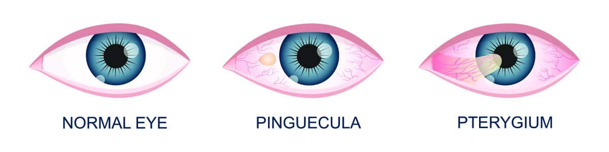 En qué casos es necesaria una cirugía para eliminar la carnosidad y ...