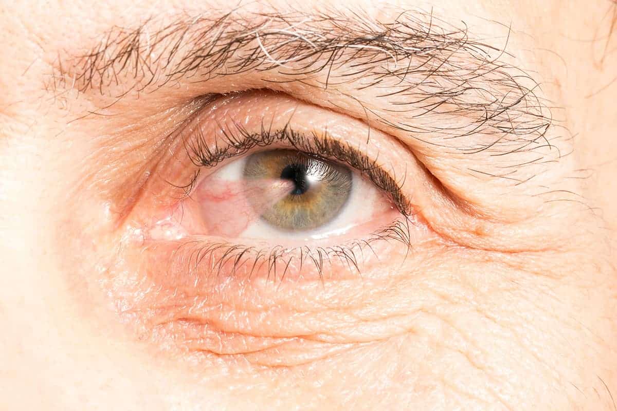 Pterygium Eye Surgery